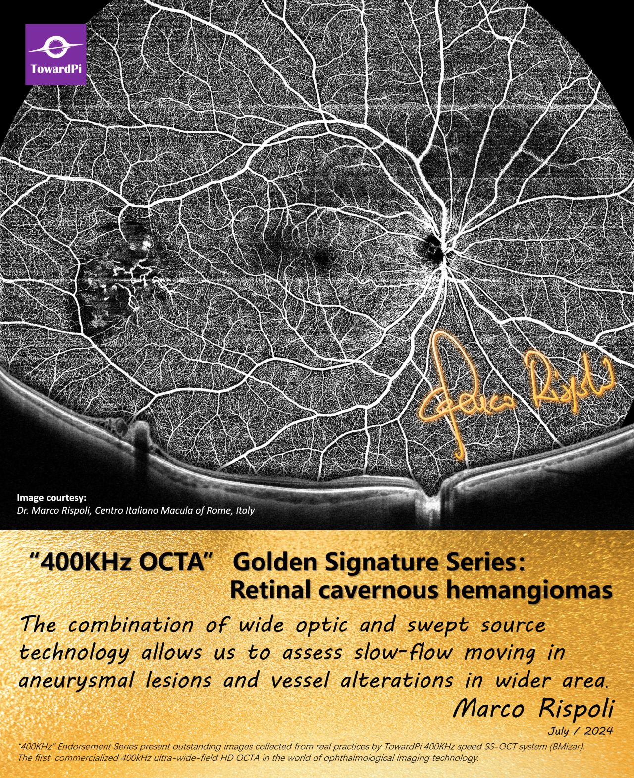 Retinal Cavernous Hemangiomas Captured with 400kHz SS-OCT/OCTA ...