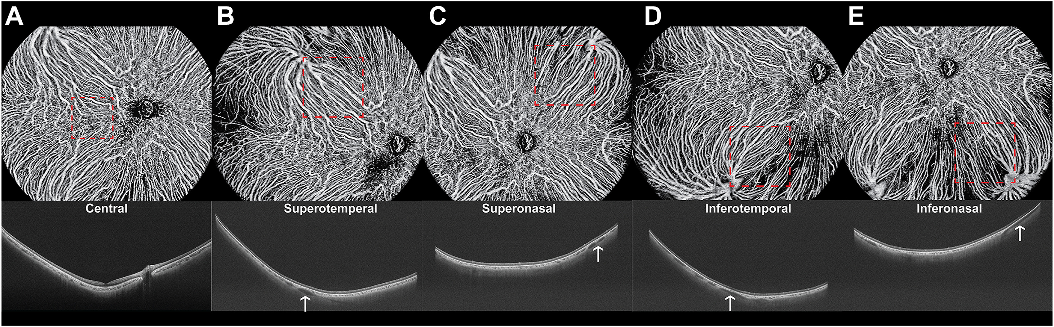 Normative Profile of Choroidal Vortex Vein Drainage System Based on UWF ...