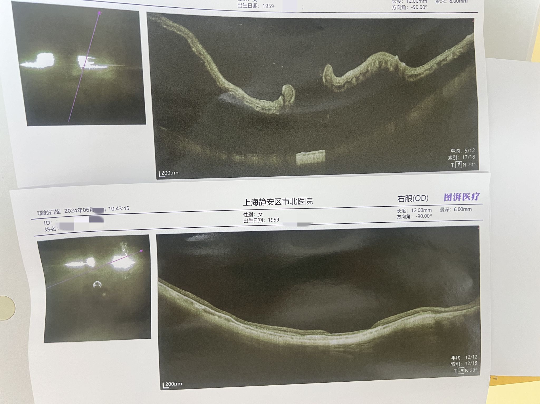 Dr. Chen's Experience with TowardPi Swept-Source OCT Yalkaid - TowardPi ...