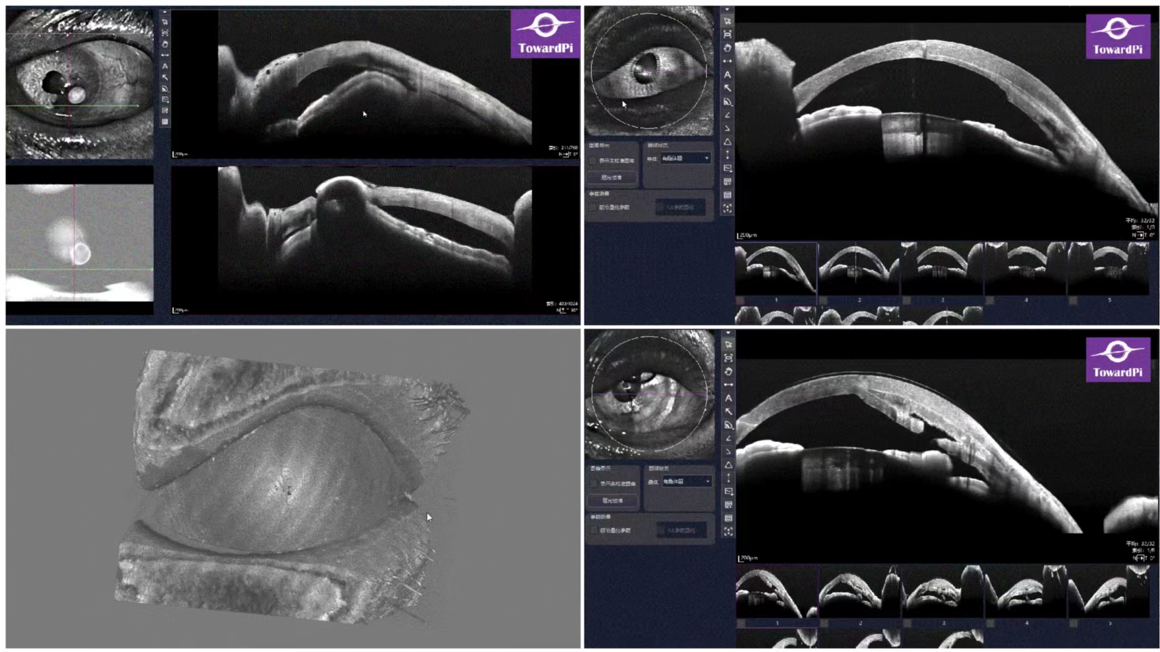 Corneal Ulcer Perforation SS-OCT, Before and After Double Lamellar ...