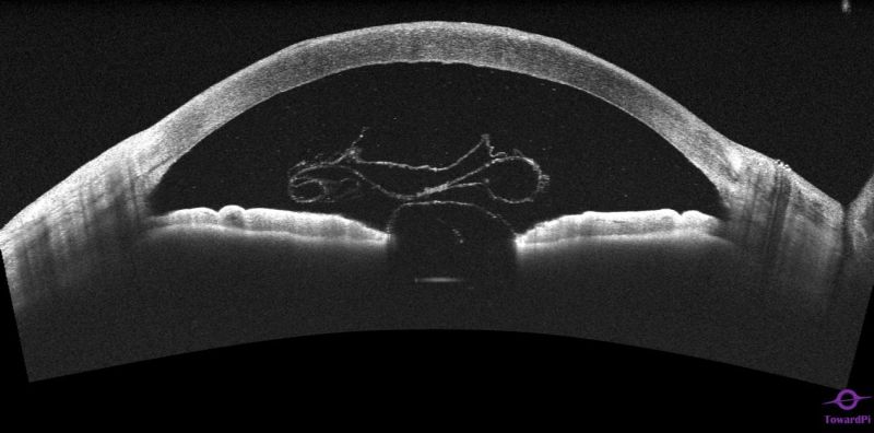 “Motorbike” in Anterior Chamber Captured by TowardPi Full-Range AS-OCT ...