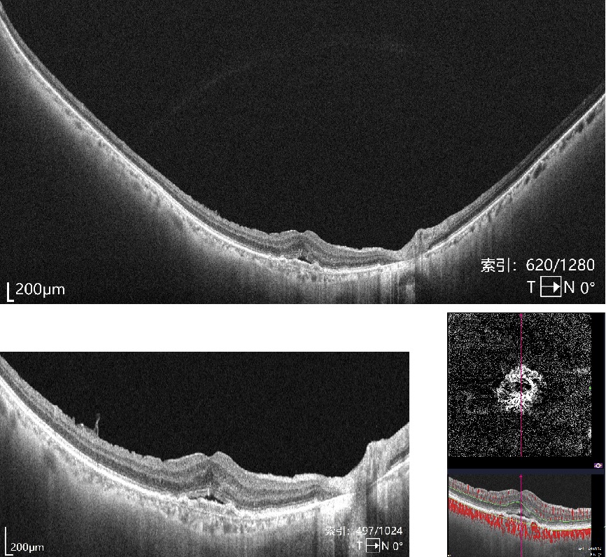 “Dimples” on Retina. OCT/Enface Image of Post ILM Peeling Surgery ...