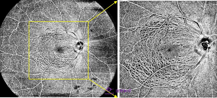 “Dimples” on Retina. OCT/Enface Image of Post ILM Peeling Surgery ...