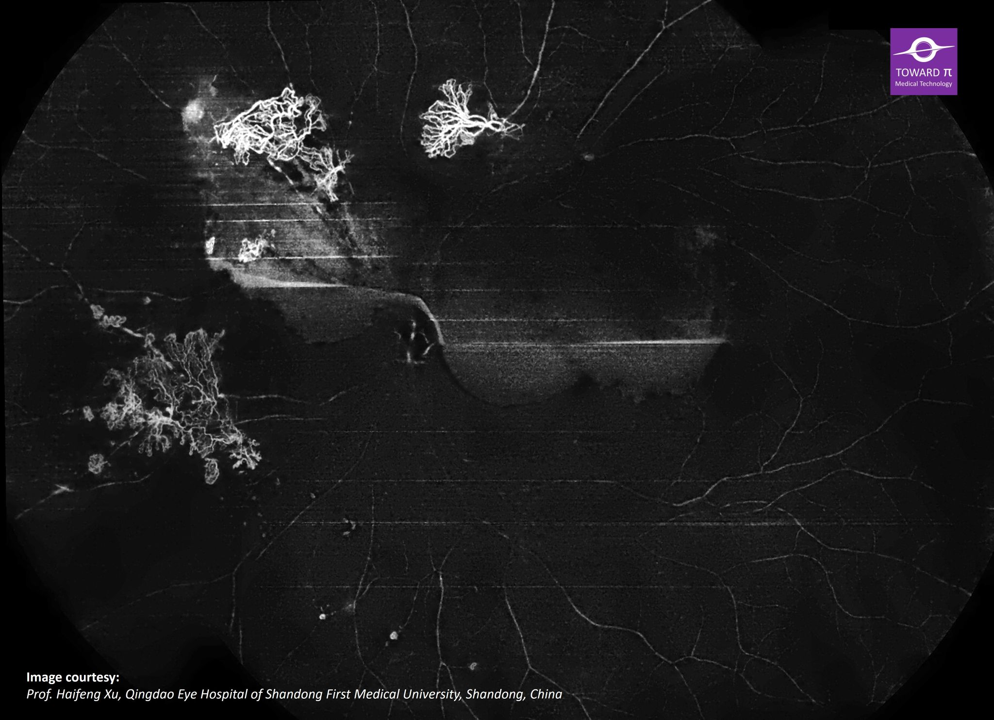 >120°OCTA Image of A PDR Eye with Preretinal Hemorrhage - TowardPi Medical