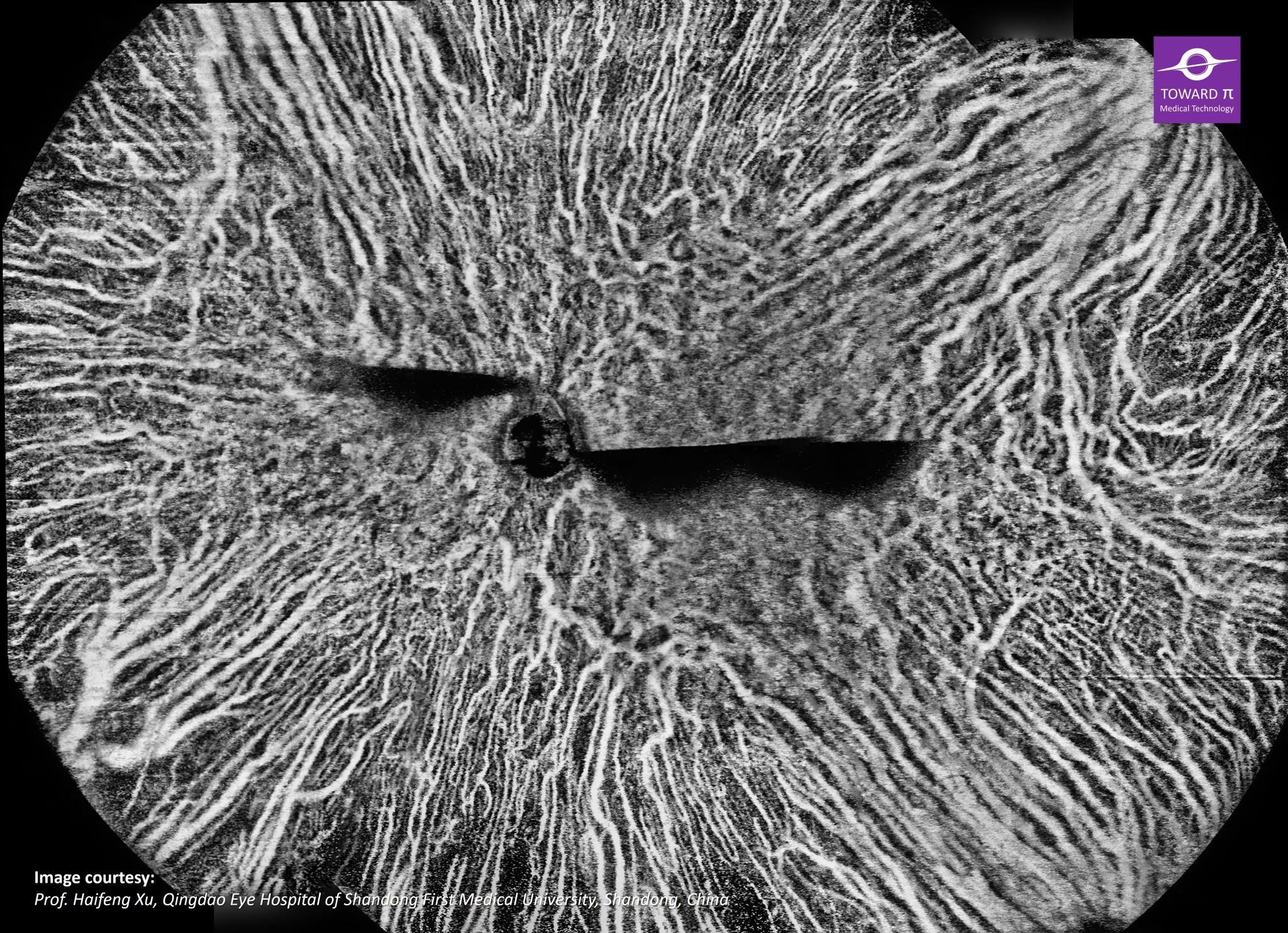 >120°OCTA Image of A PDR Eye with Preretinal Hemorrhage - TowardPi Medical