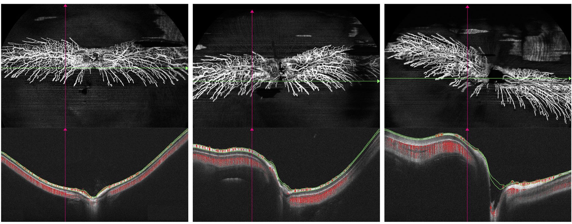 A Wireless Battery-free Eye Modulation Patch for High Myopia Therapy ...