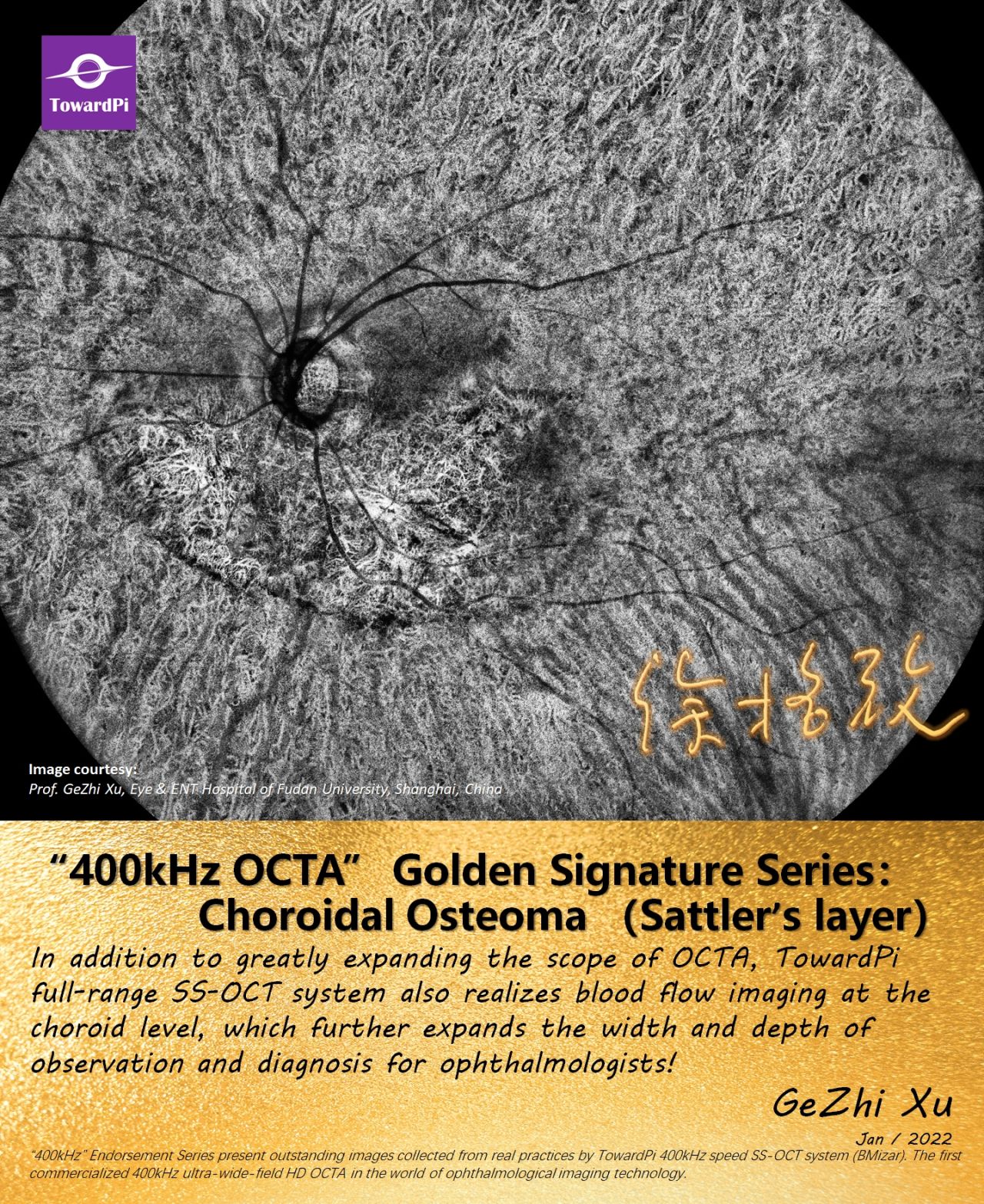 Choroidal Osteoma (Sattler's layer), OCTA Single Scan - TowardPi Medical