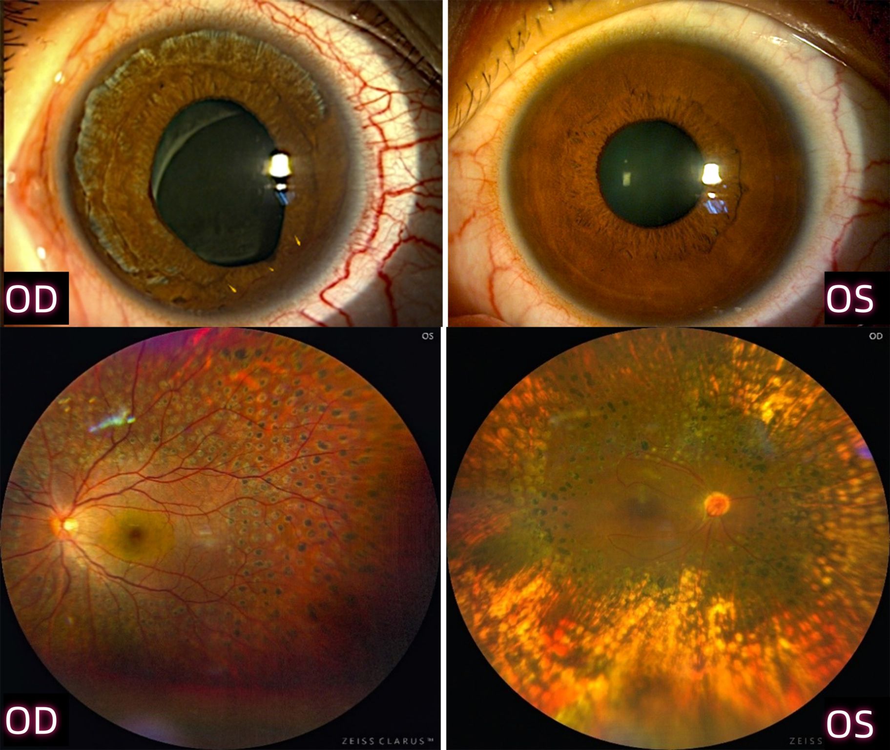 Corolla in the Fundus, Ultra-widefield OCTA of Takayasu Arteritis ...