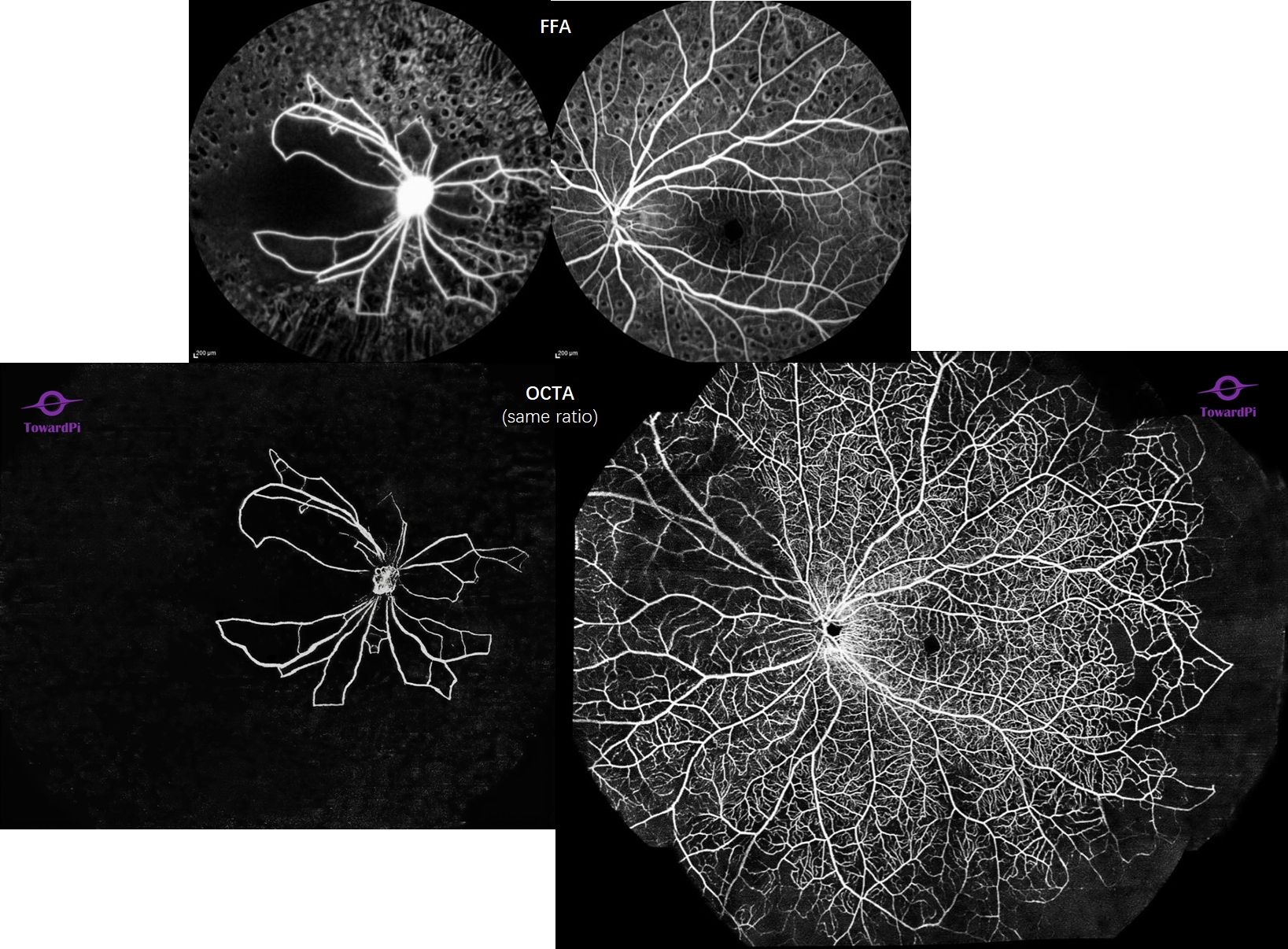 Corolla in the Fundus, Ultra-widefield OCTA of Takayasu Arteritis ...