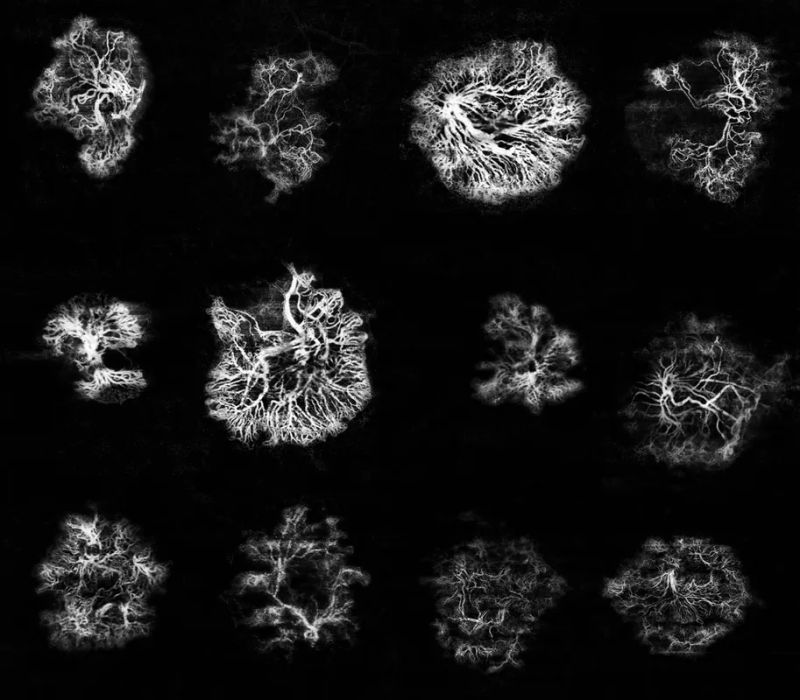 Detection of MNV on OCTA Using TowardPi Full-Range OCTA - TowardPi Medical
