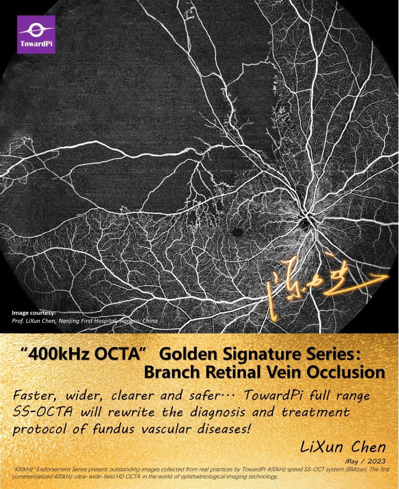 Branch Retinal Vein Occlusion, BRVO, OCTA Single Scan - TowardPi Medical