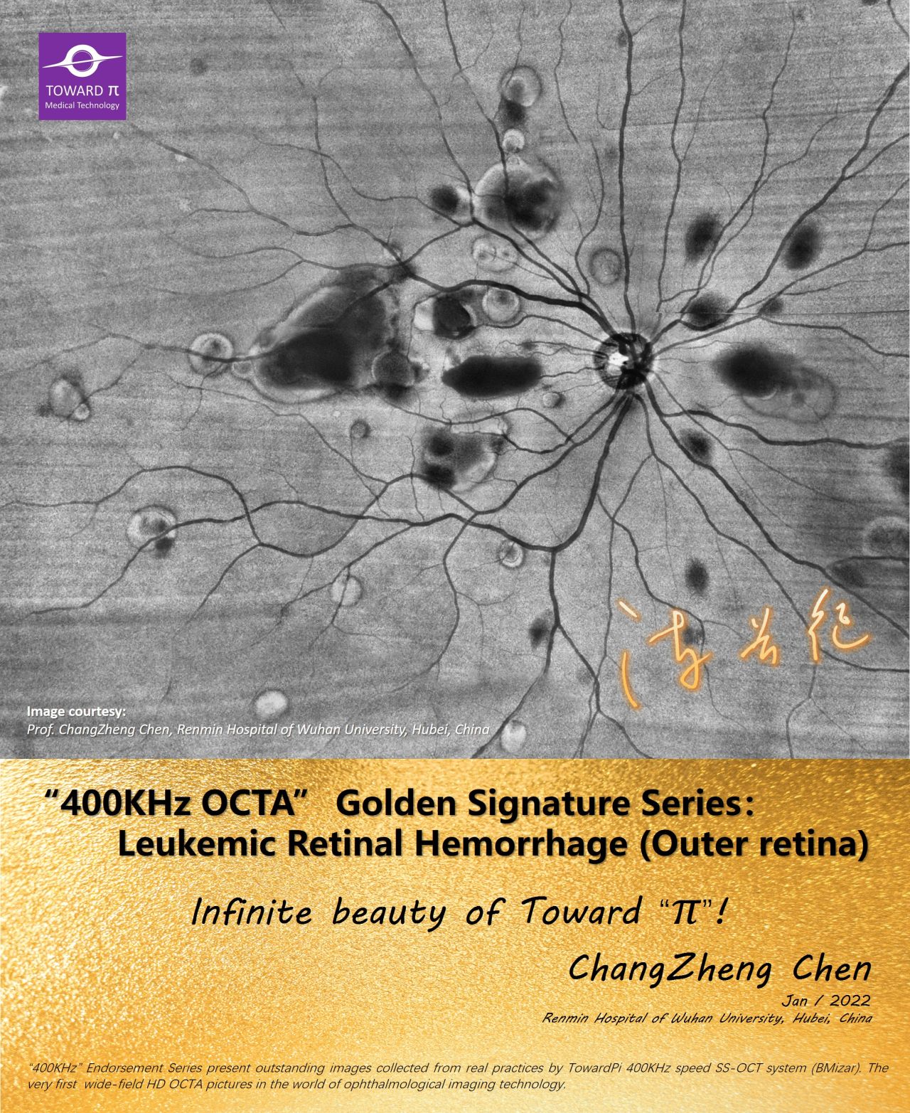 Leukemic Multiple Retinal Hemorrhages, Ultra-wide OCT Enface Image ...