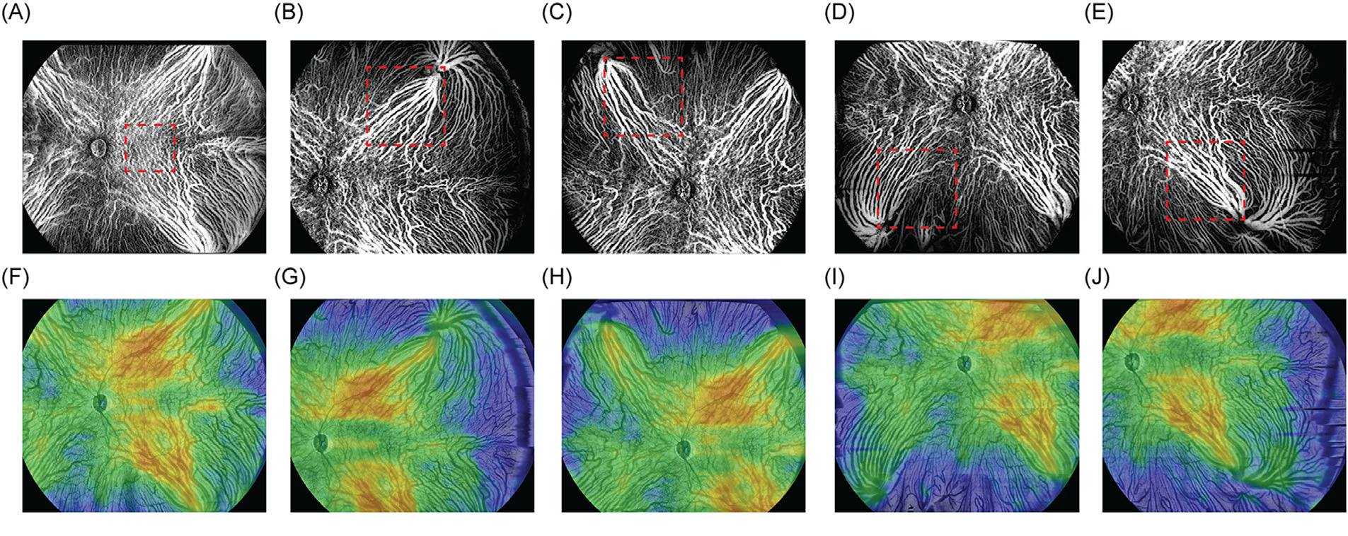 Asymmetric Vortex Vein Drainage System Plays a Key Role in CSC ...