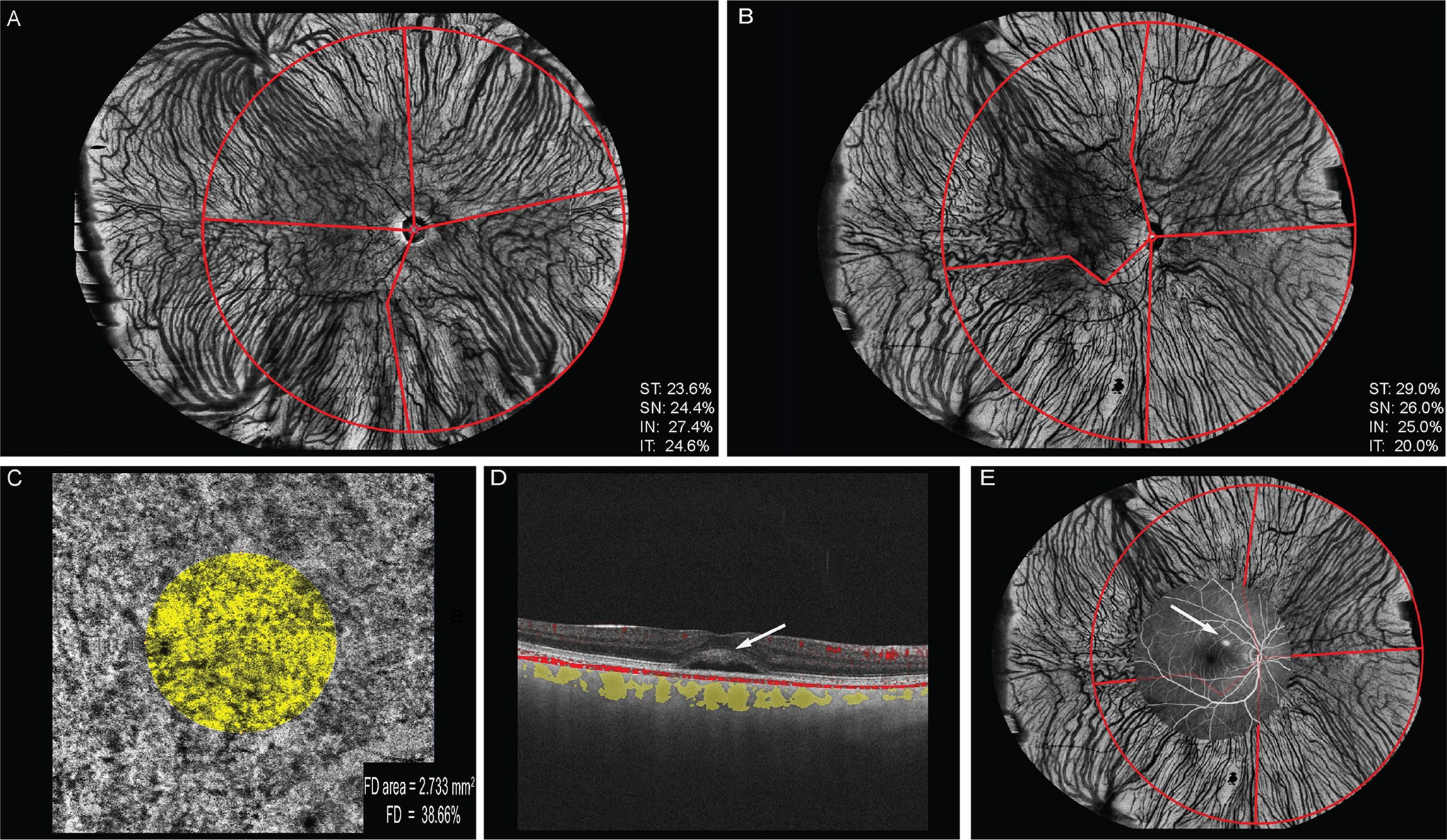 Asymmetric Vortex Vein Drainage System Plays a Key Role in CSC ...