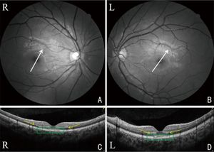 OCT features of AMN lesions following COVID infection - TowardPi Medical