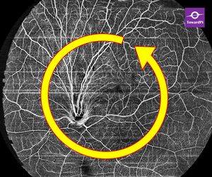 Congenital Ectopic Macula with Optic Disc Rotation, OCT Angiography ...