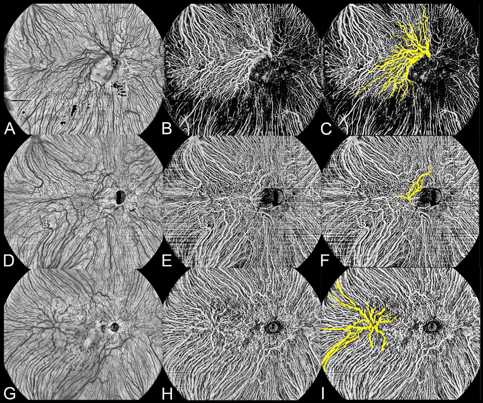 Posterior Vortex Veins in Healthy Eyes Captured by Ultra-widefield OCTA ...