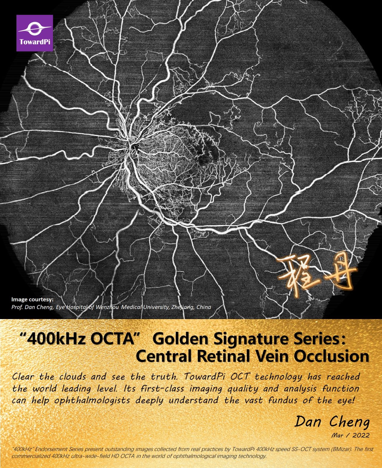 Central Retinal Vein Occlusion Captured by 400 kHz OCTA BMizar ...