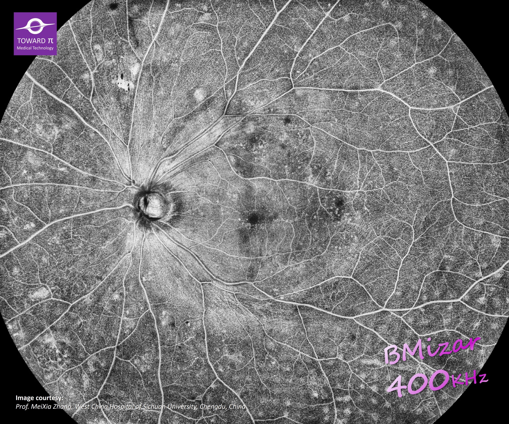 Pan-Retinal Photocoagulation (PRP) Laser Spots from Outer (Avascular ...