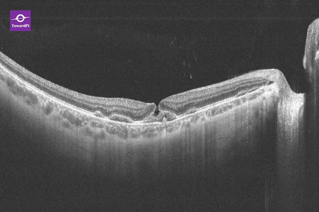 choroidal rupture
