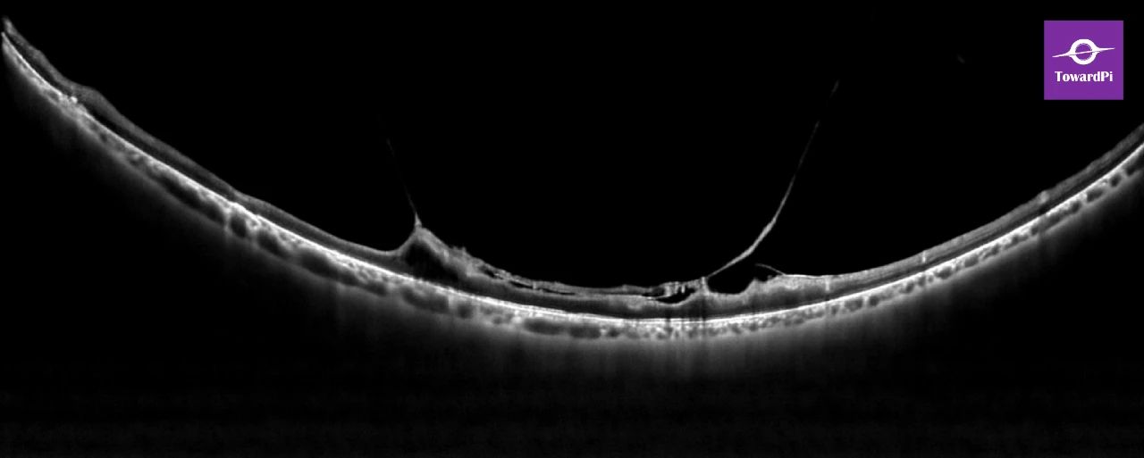 Gladiolus in the Fundus - TowardPi Medical
