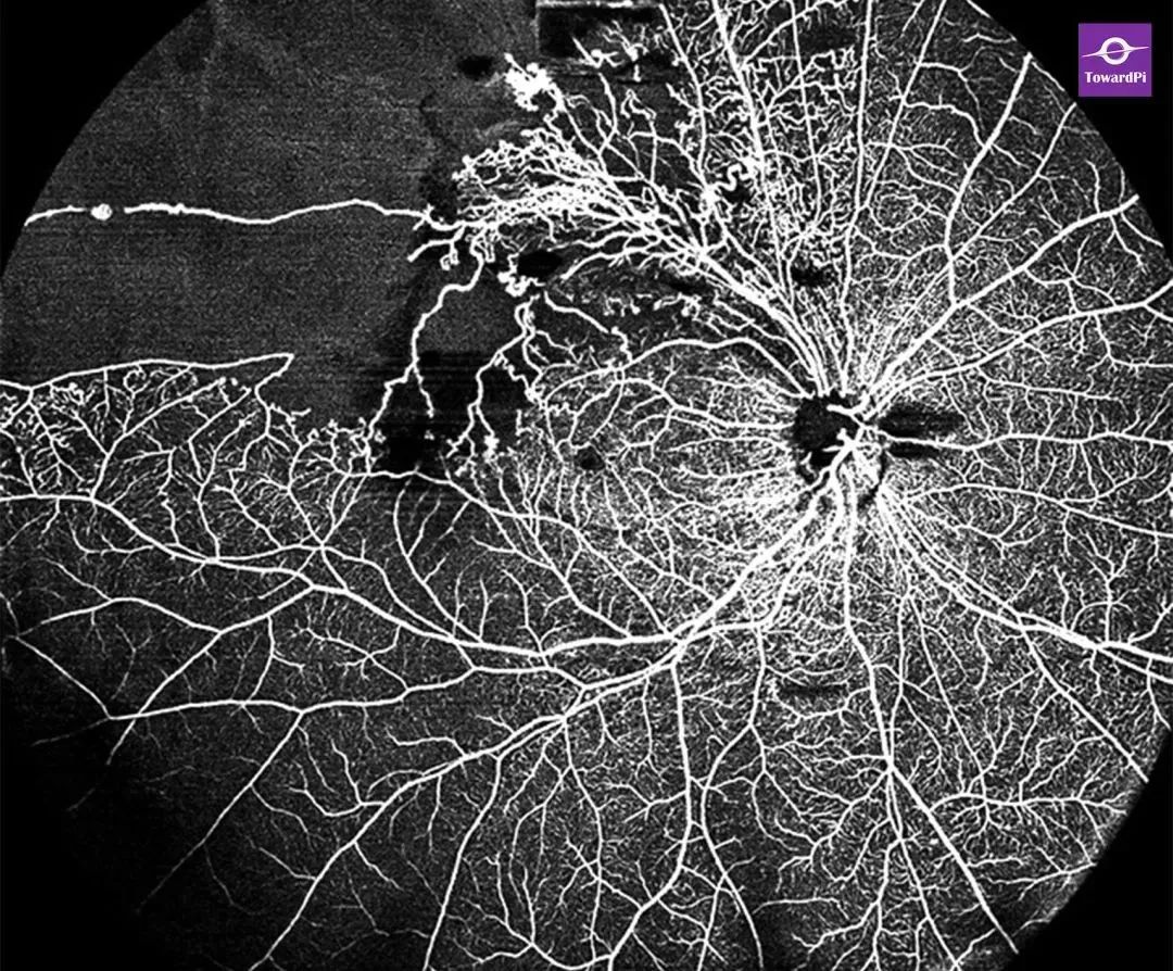 Gladiolus in the Fundus - TowardPi Medical