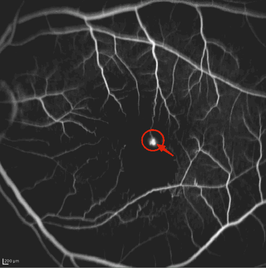 120° OCTA Scan in the Management of BRVO. - TowardPi Medical