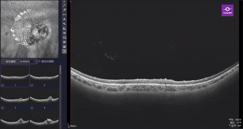 Pediatric CHRRPE Case Revealed by Full-Range SS-OCTA - TowardPi Medical