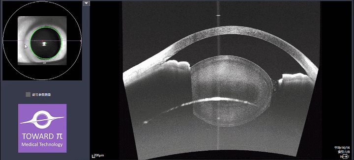 Ectopia Lentis from Marfan Syndrome - TowardPi Medical