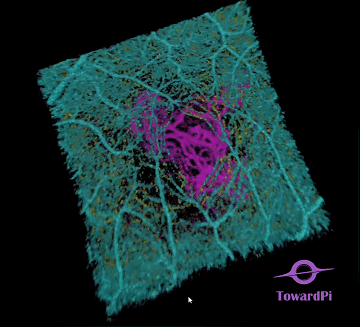 3D-OCTA Episode2: PCV in Macula - TowardPi Medical