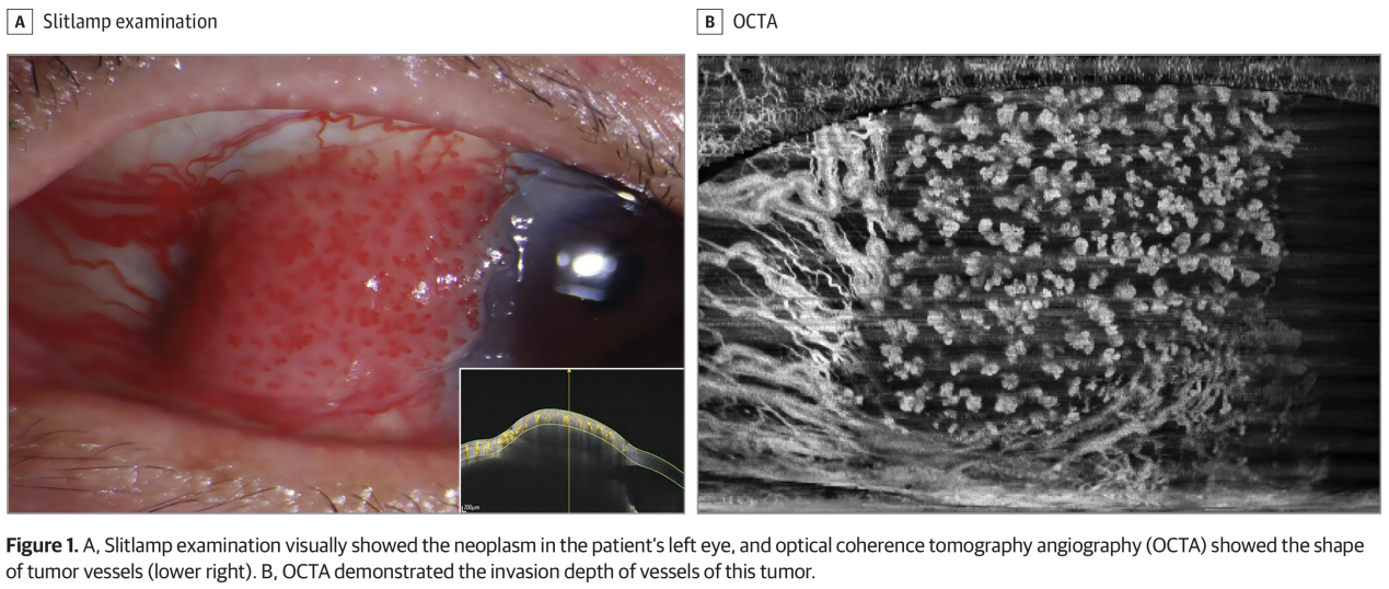 Popcorns in Conjunctiva Revealed by AS SS-OCTA - TowardPi Medical