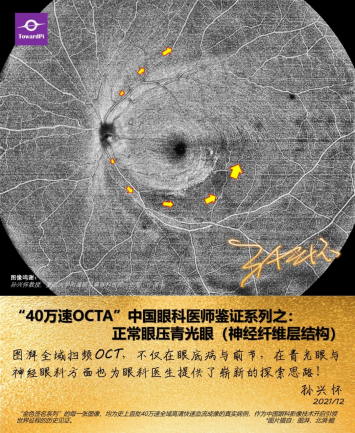Full-field Swept-source OCT, Expanding New Thoughts in Glaucoma and ...