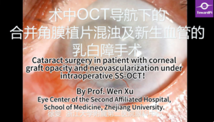 Complicated but Confident Cataract Surgery Under Intraoperative SS-OCT ...