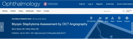 3D scanning OCTA for myopic posterior scleral staphyloma, the first ...