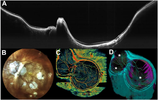 3D scanning OCTA for myopic posterior scleral staphyloma, the first ...